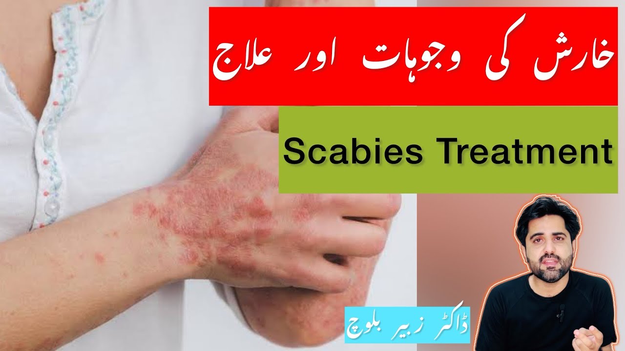 Scabies ka ilaj in Urdu | Scabies Treatment | Kharish khatam karne ka ...