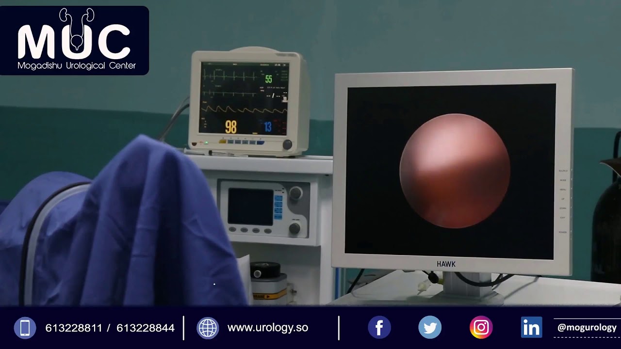 Bladder Stone Surgery using Laser. Duration of the procedure: 30minute ...