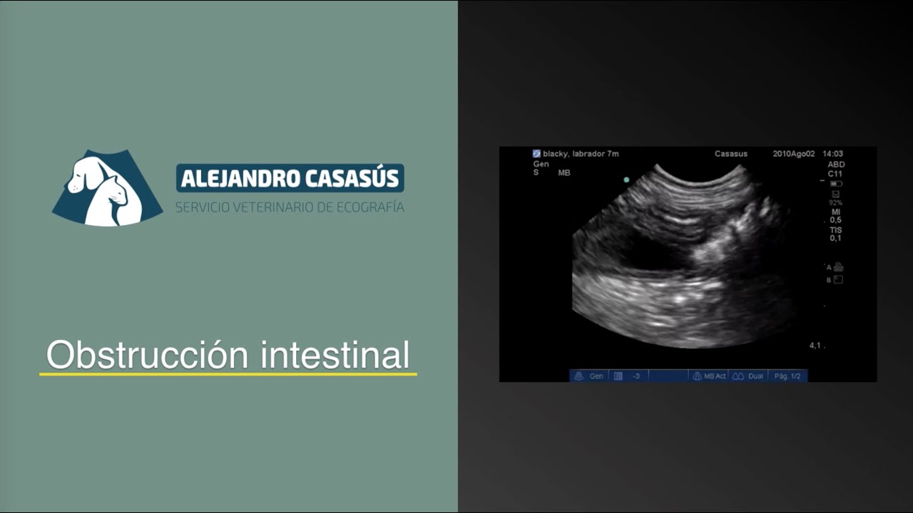 Obstrucción intestinal - YouTube