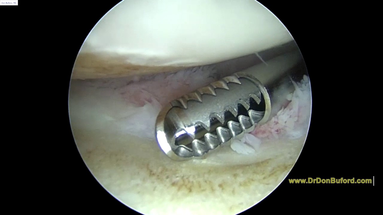 Left Shoulder Debridement, Biceps tenodesis 2017 06 12 082041 DY - YouTube