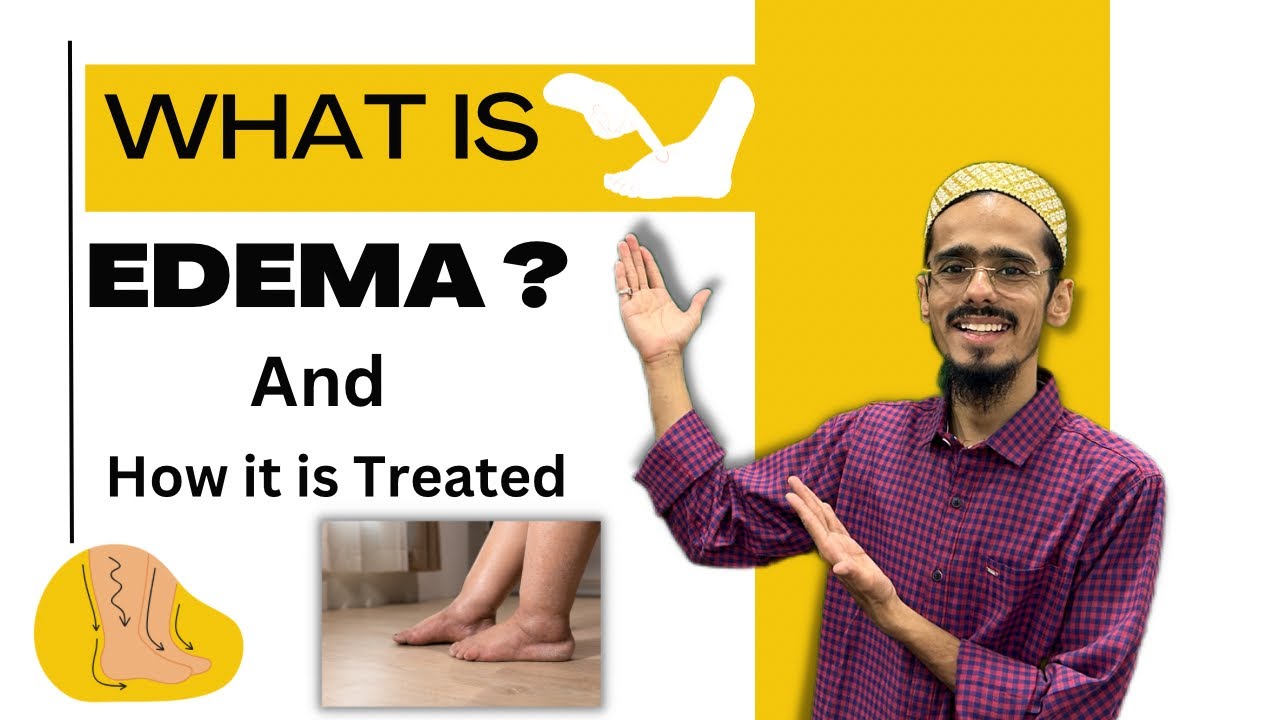 What is Edema ? | Edema Causes | Edema Types | Edema Treatment - YouTube