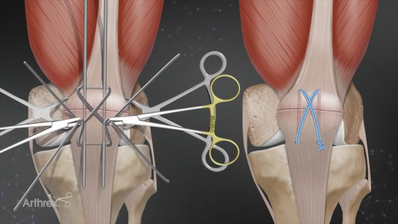 ABBA Medicina Deportiva Sistema de Manejo de Fractura Patelar - YouTube