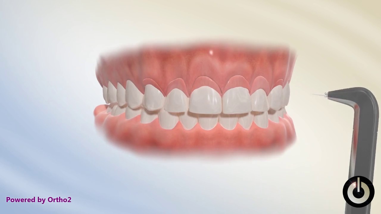Laser Gingivectomy - YouTube