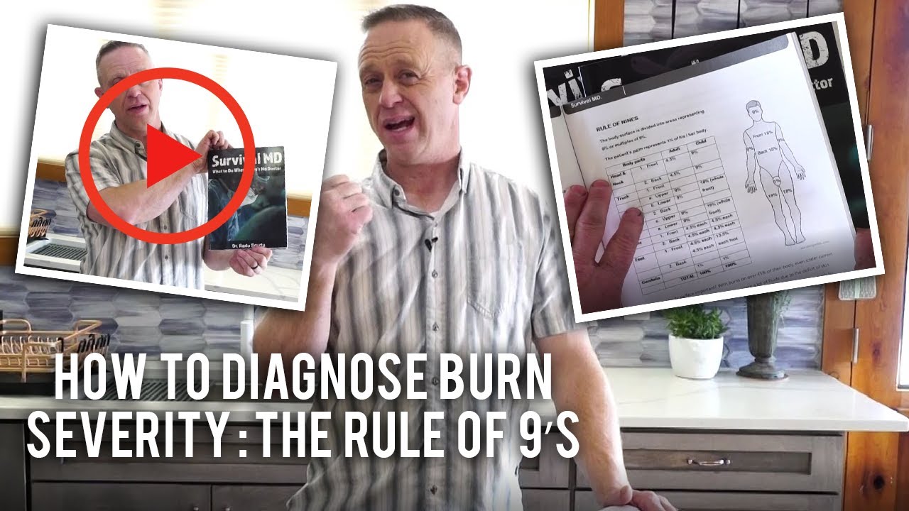How to Diagnose Burn Severity The Rule of 9’s - YouTube