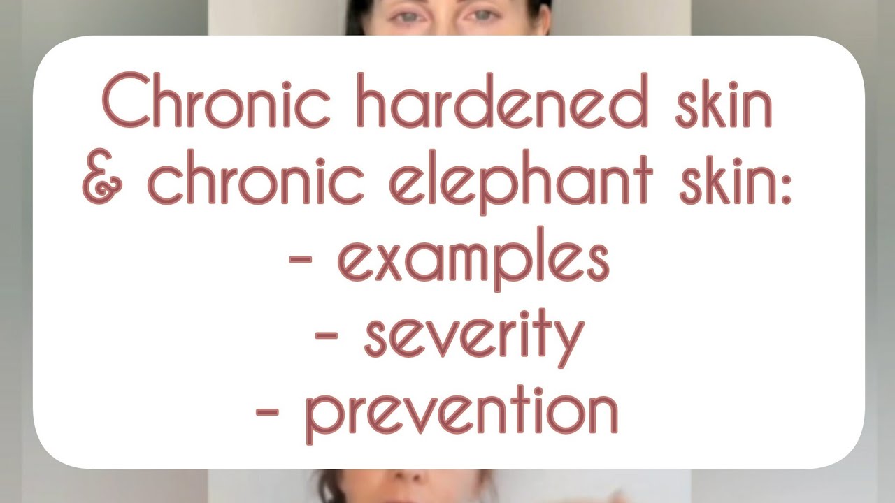 Chronic hardened skin and chronic elephant skin during Topical Steroid ...