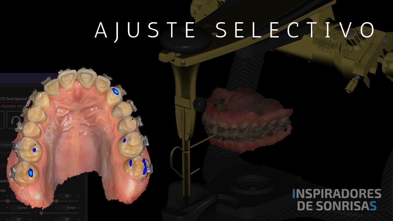 Ajuste Selectivo 💥 Control ajuste oclusal - YouTube
