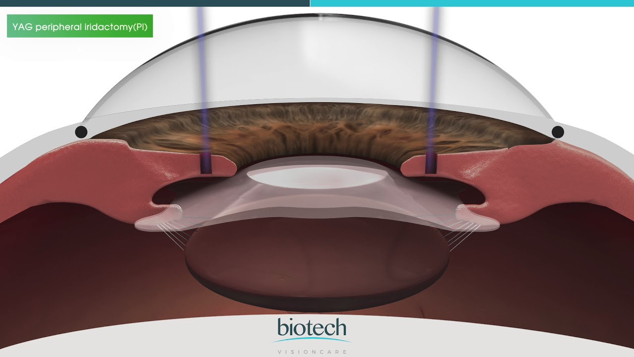 Eyecryl PHAKIC Range Role of Central Hole - YouTube