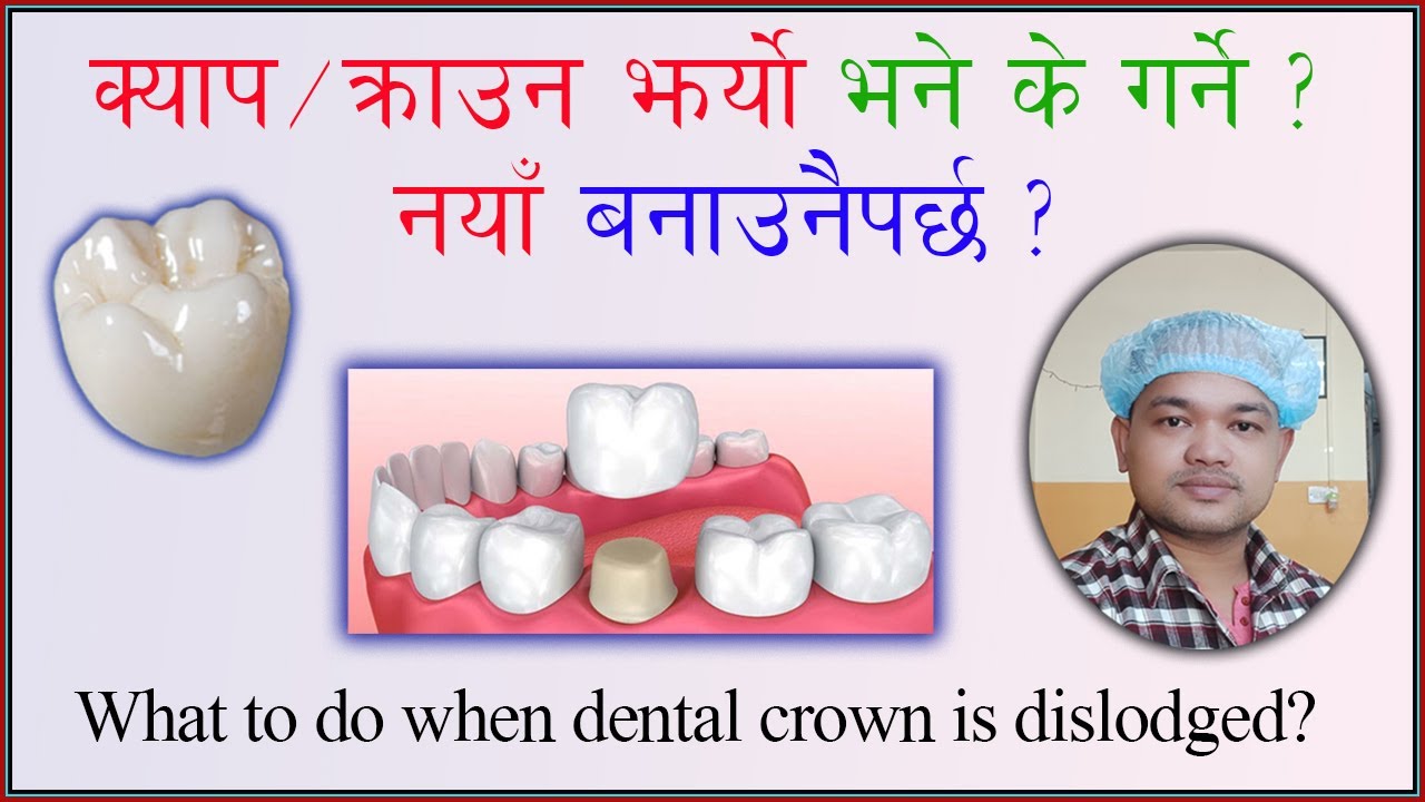 क्याप/कभर झर्यो भने के गर्ने? नयाँ बनाउनैपर्छ?/ Dislodged Crown ...