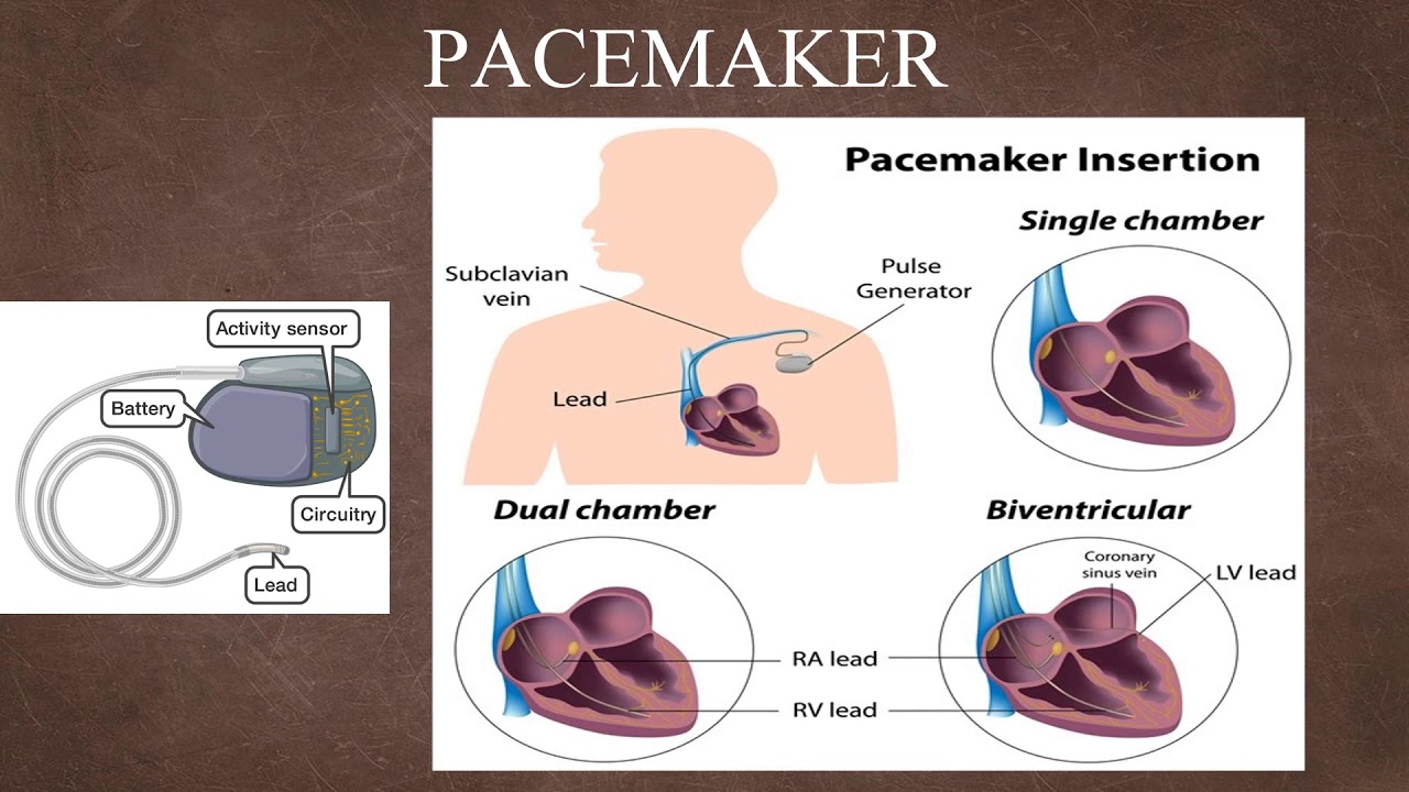 Pacemaker - YouTube