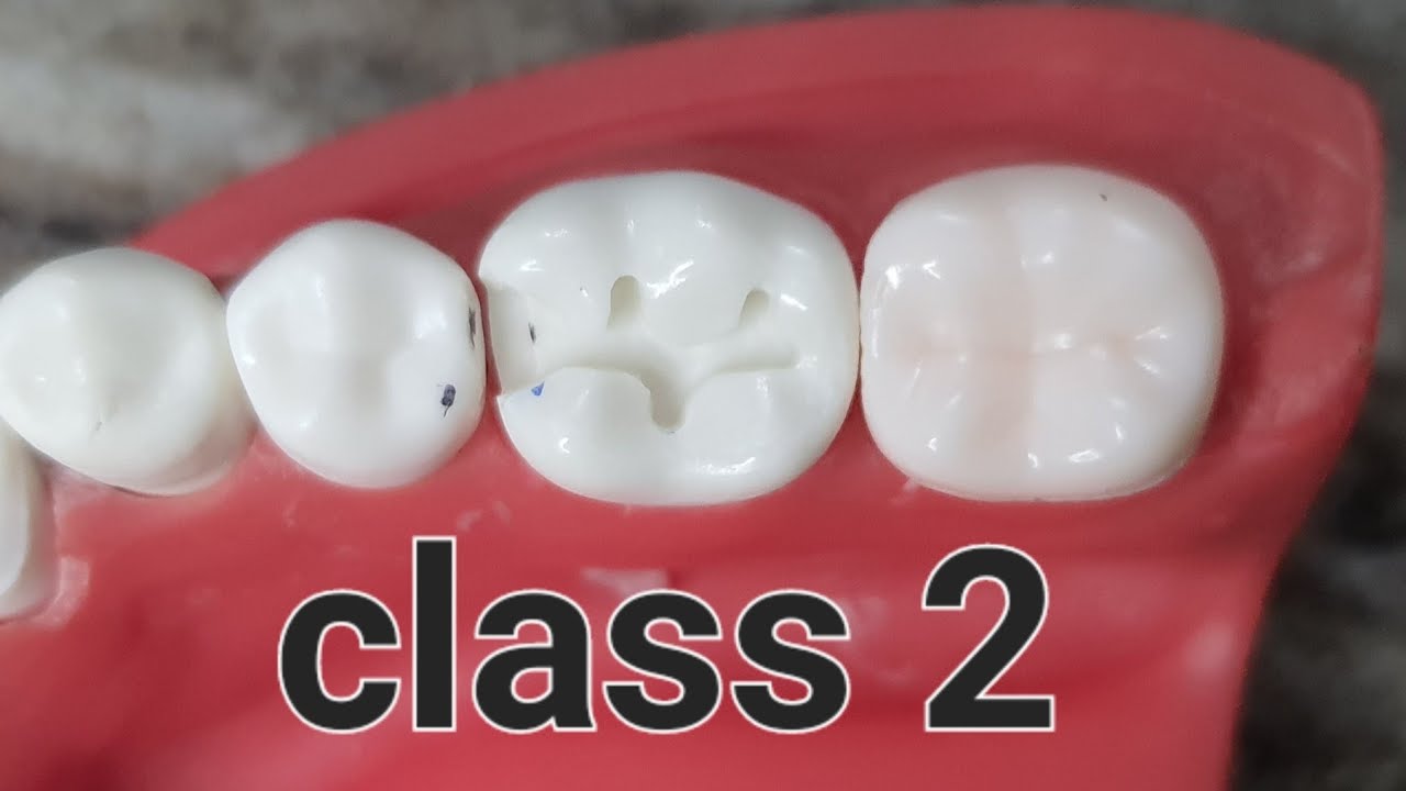 class 2 cavity preparation for lower 6 ⁉️شرح مهم جدا ⁉️ - YouTube