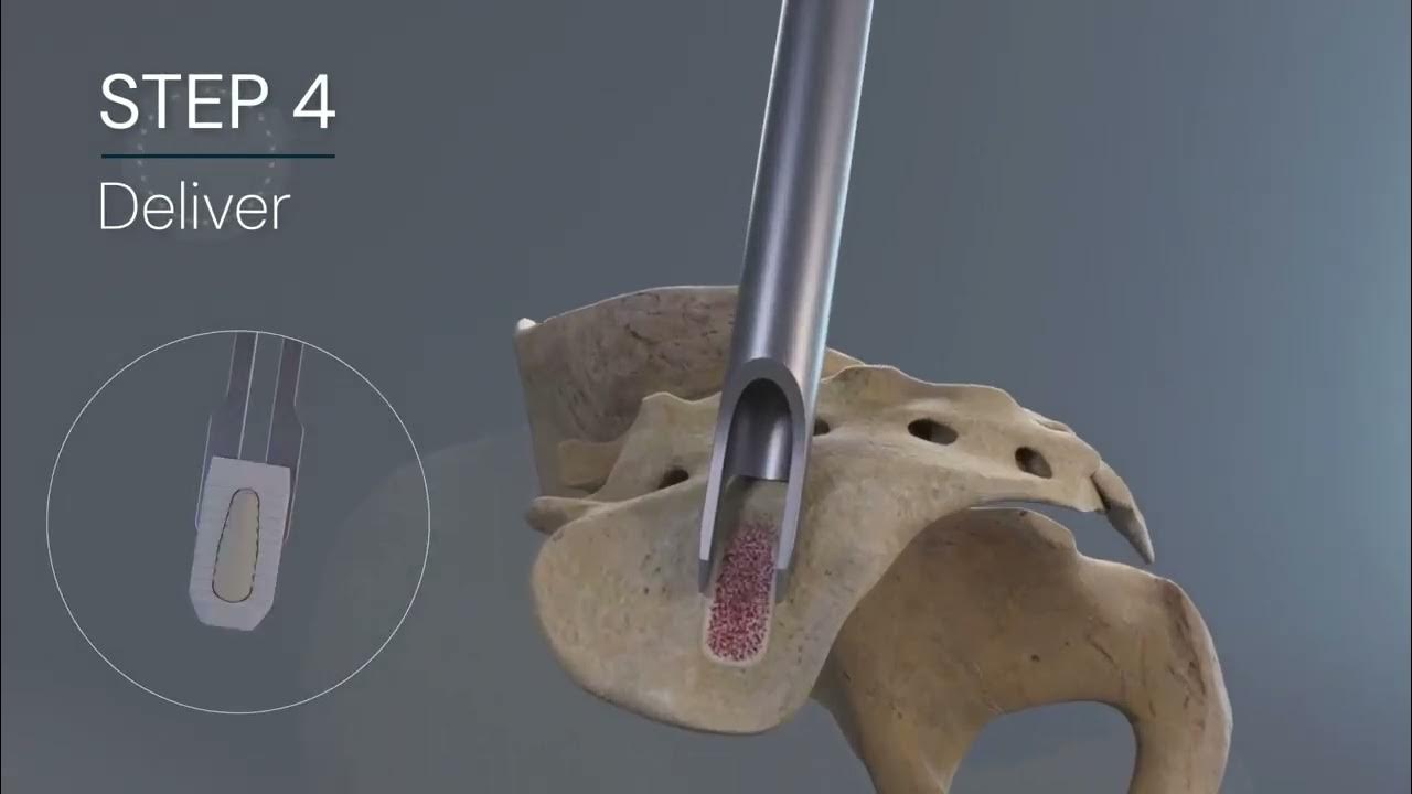 PainTEQ: LinQ Sacroiliac Joint Stabilization and Fusion Procedure - YouTube