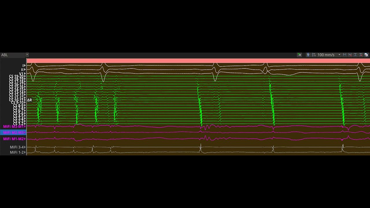 AF Termination during Pivot RF ablation - YouTube