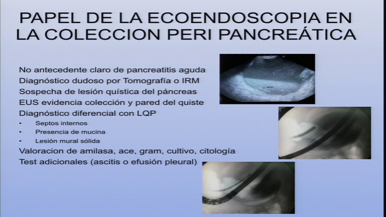 17 Pseudoquiste pancreático Tratamiento endoscópico vs quirúrgico - YouTube