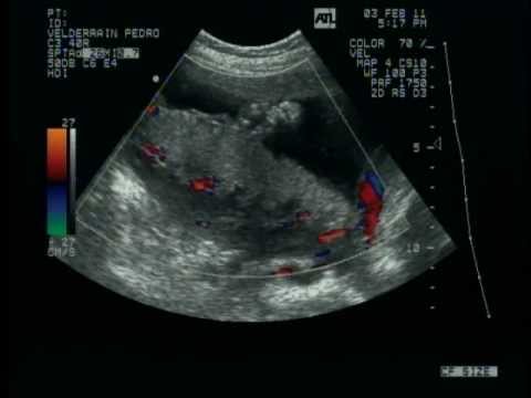 Fetus papyraceus - YouTube