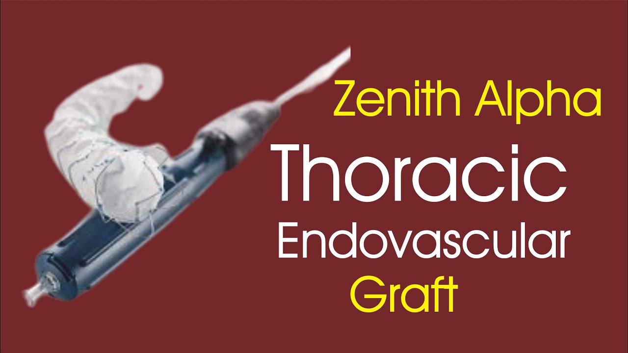 Zenith Alpha™ Thoracic Endovascular Graft Proximal Component - YouTube