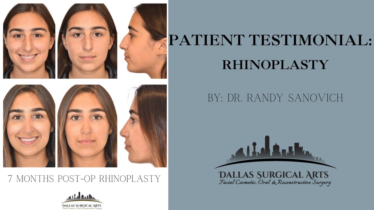 Patient Testimonial: Rhinoplasty by Dr. Randy Sanovich - YouTube