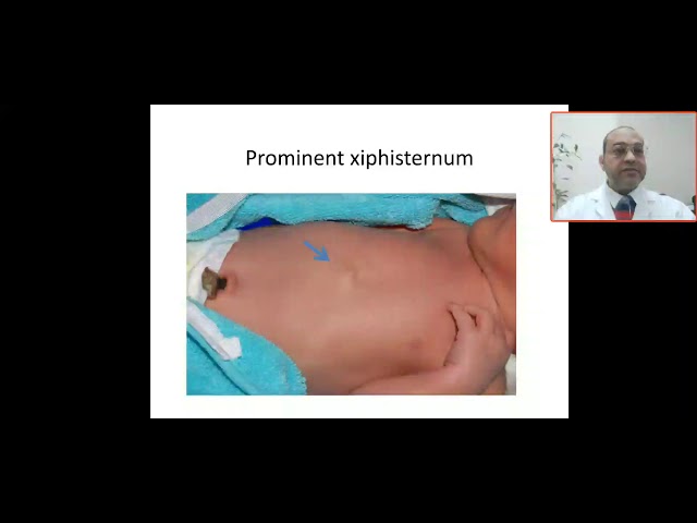 Protruding Xiphoid Process Surgery