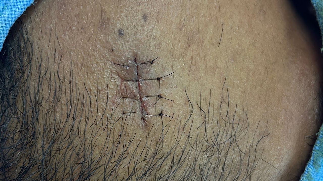 Easy Suture technique for skin closure| scarless suturing technique ...