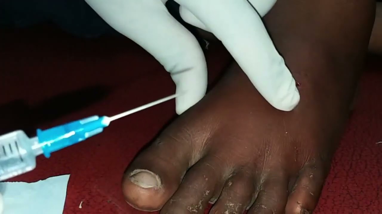 FOREIGN BODY REMOVAL - YouTube