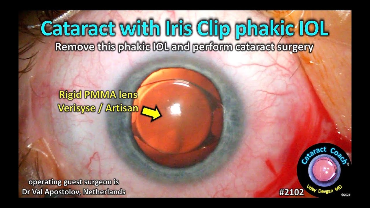 CataractCoach™ 2102: cataract with iris clip phakic IOL (artisan, Wörst ...