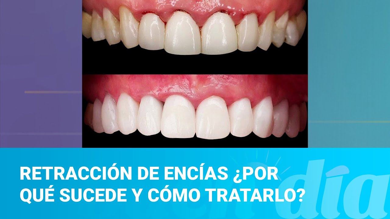 Retracción de encías ¿por qué sucede y cómo tratarlo? - YouTube