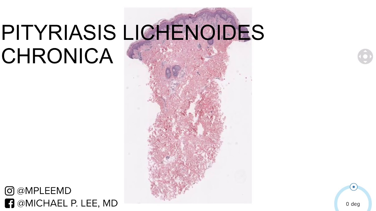 Pityriasis Lichenoides Chronica. Dermpath Made Easy. - YouTube