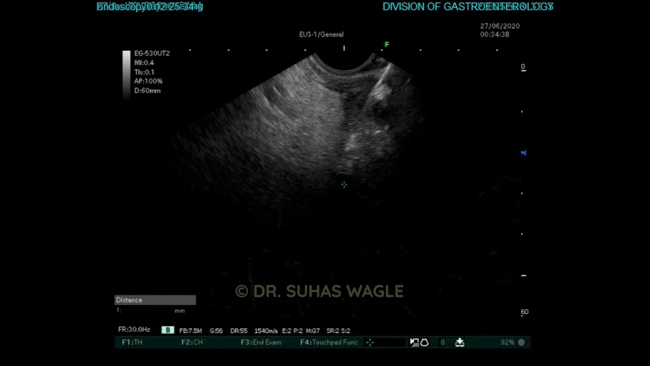 EUS guided cystogastrostomy for WON drainage - YouTube