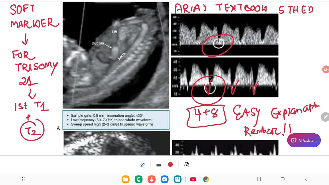 Soft marker for chromosomal Abnormality # Ultrasound marker/easy ...