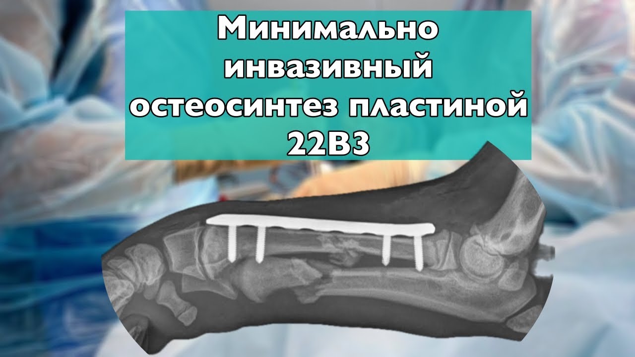 Minimally invasive plate osteosynthesis (MIPO) in dog (4K) - YouTube