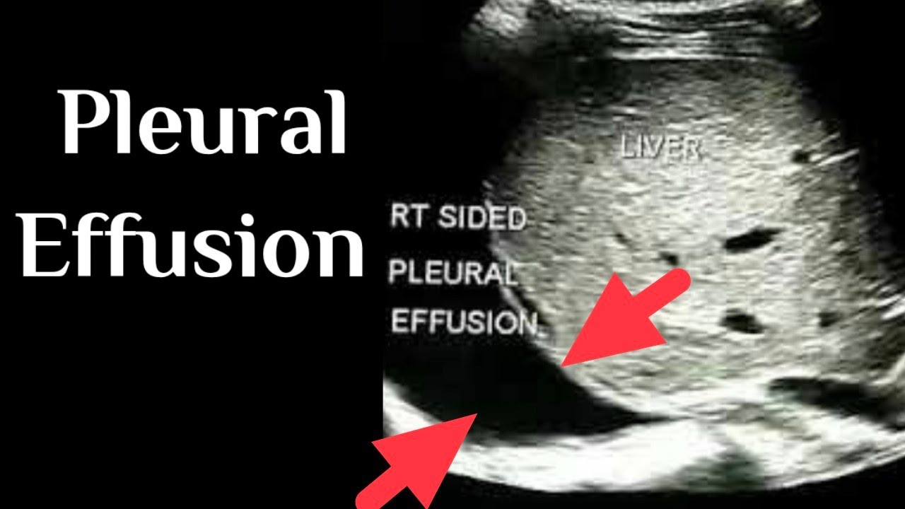 Ultrasound video showing Right sided Pleural Effusion - YouTube