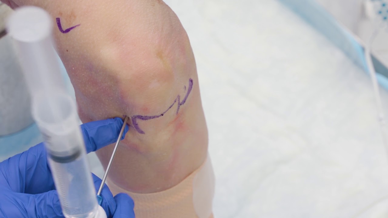 Dr. McMillan - Navigating Around the Fat Pad - YouTube