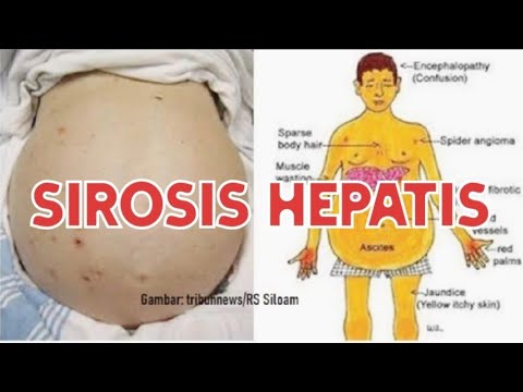 Sirosis Hepatis ! Perut Membesar Tidak Semuanya Kembung, Bisa Jadi ...