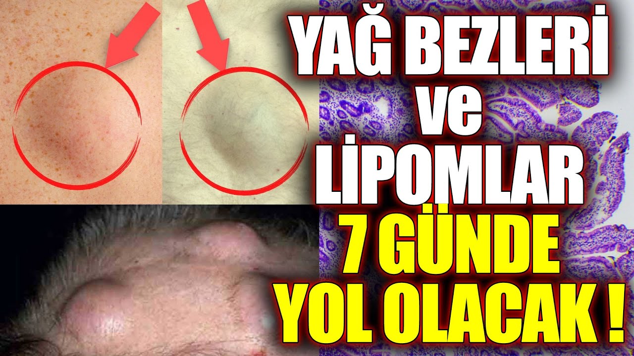Yağ Bezeleri ve Lipomlardan 7 GÜNDE TAMAMEN KURTARACAK DOĞAL YÖNTEM ...