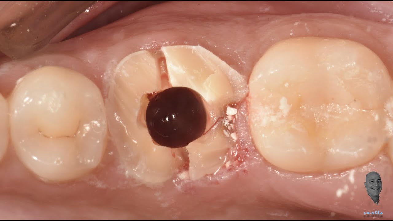 Cicatrizador Personalizado em Implantodontia Custom Healing Cap in ...