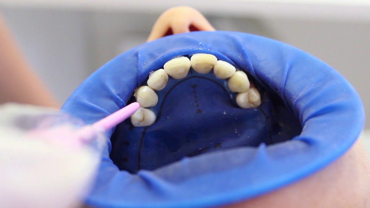 Pose d’une contention Memotain - YouTube