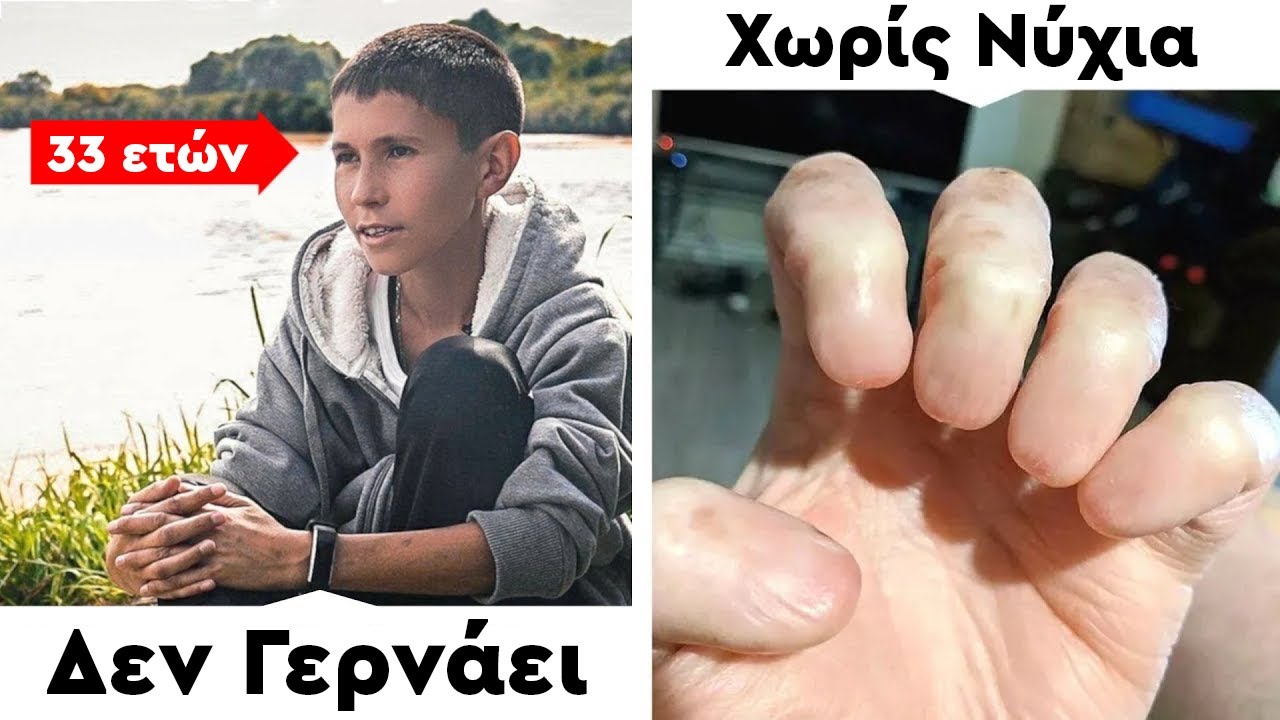 8 άνθρωποι με εξαιρετικά περίεργες ασθένειες - YouTube