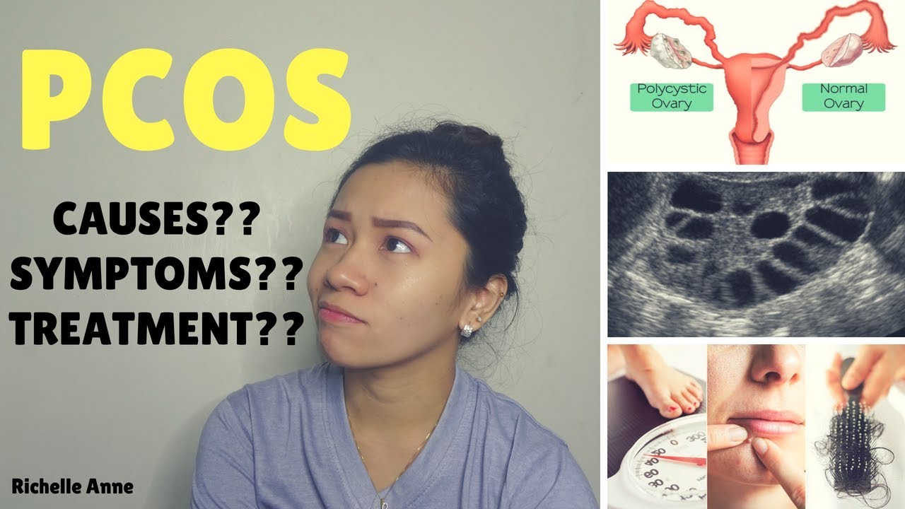 PCOS Causes Symptoms Treatment Tagalog YouTube pcos-causes-symptoms-treatment-tagalog-youtube