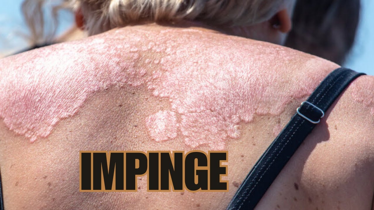 Desvendando a Impinge: Causas, Sintomas e Tratamento - YouTube