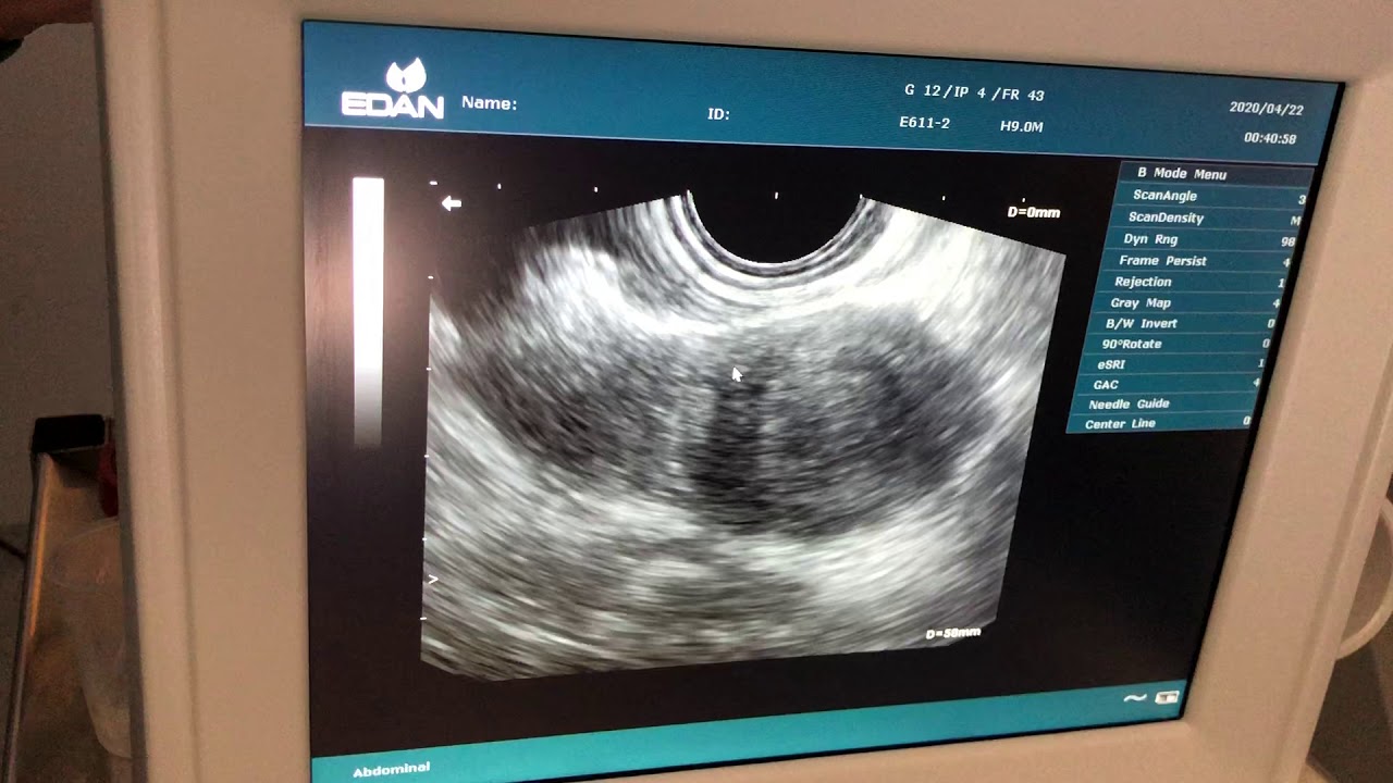 Intra-operative Ultrasound Robert's Uterus - YouTube