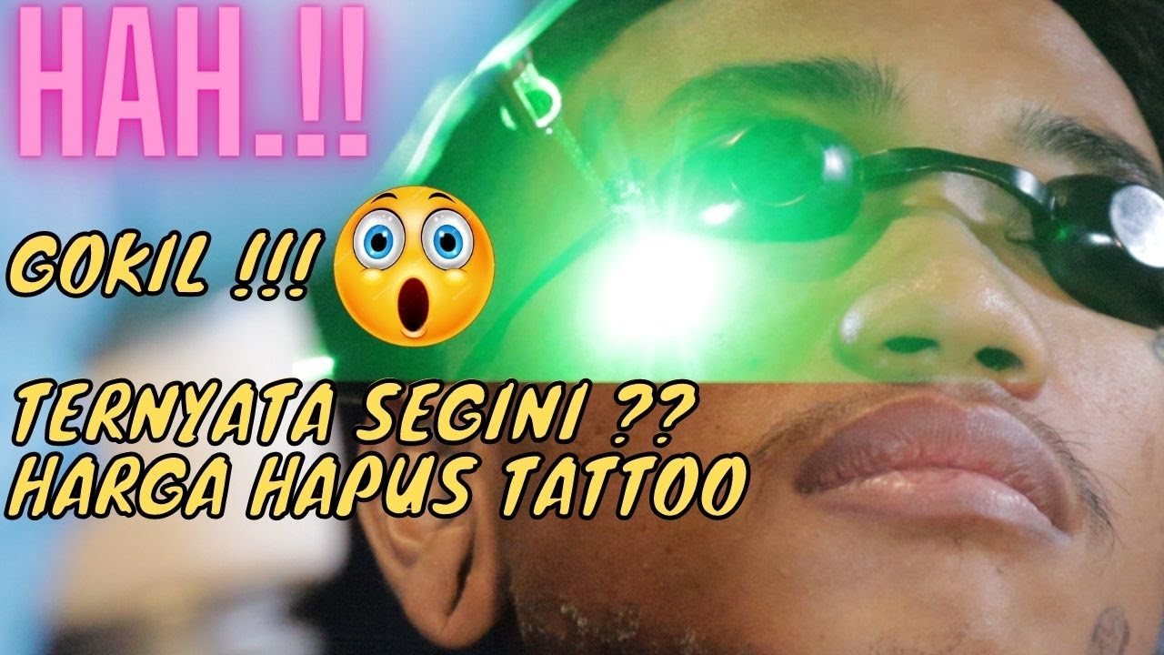 karena ingin MENIKAH harus hapus tattoo | removal Tattoo - YouTube