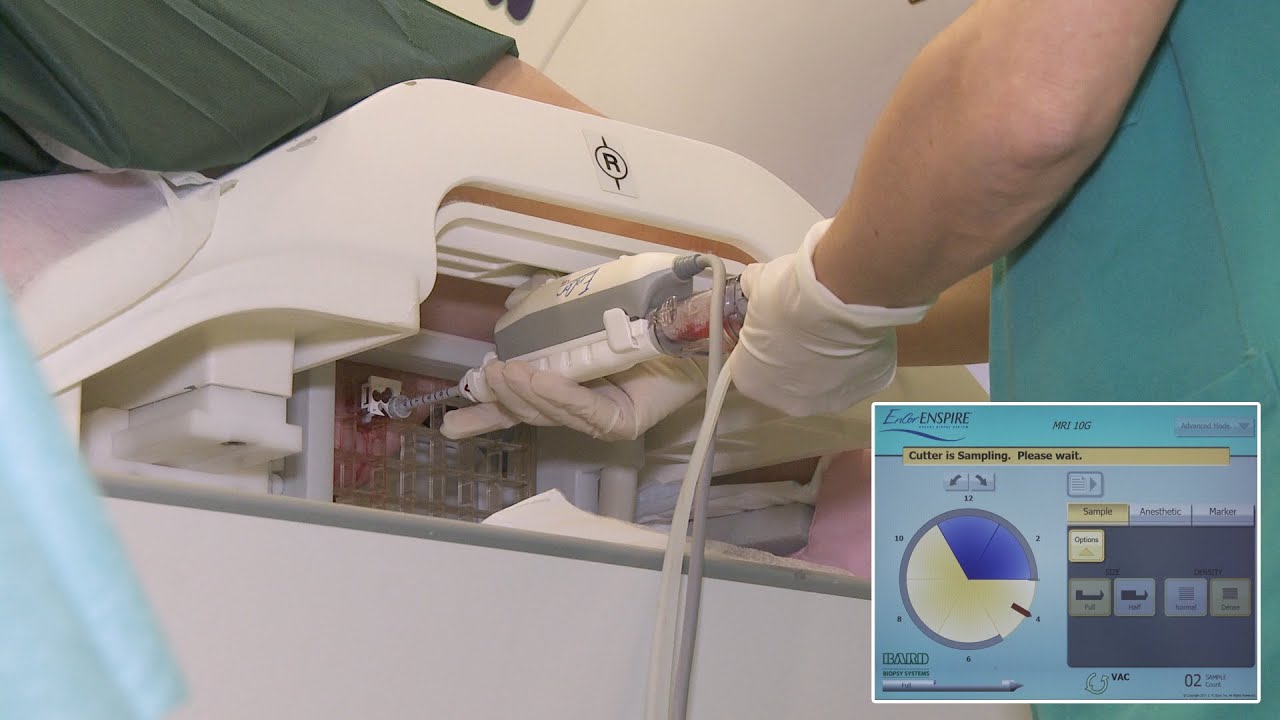 VAB - Tomosynthesis guide Clinical Case - EnCor & Affirm – BD Europe ...