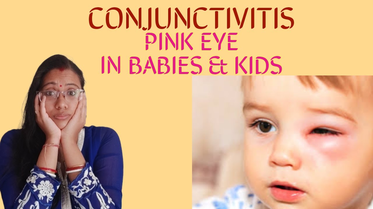CONJUNCTIVITIS (PINK EYE) IN BABIES N KIDS, CAUSE, SIGNS ,PREVENTION ...
