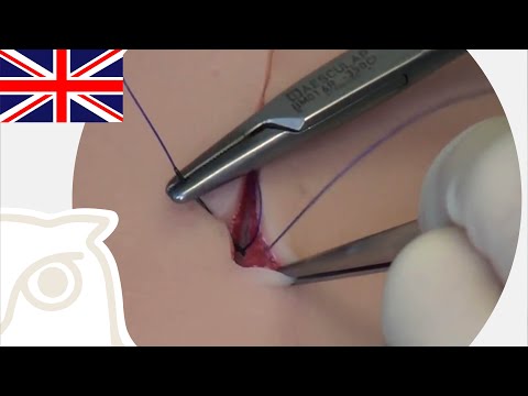 CSL: subcutaneous suture