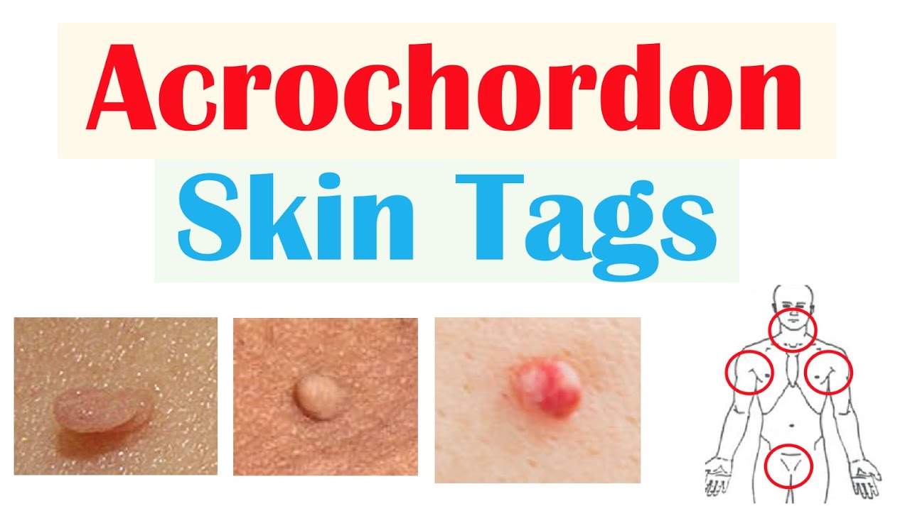 Skin Tags (Acrochordons) | Causes, Risk Factors, Symptoms, Diagnosis ...