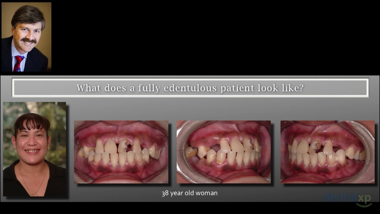3D Immediate Transformation of The Fully Edentulous Patient - YouTube