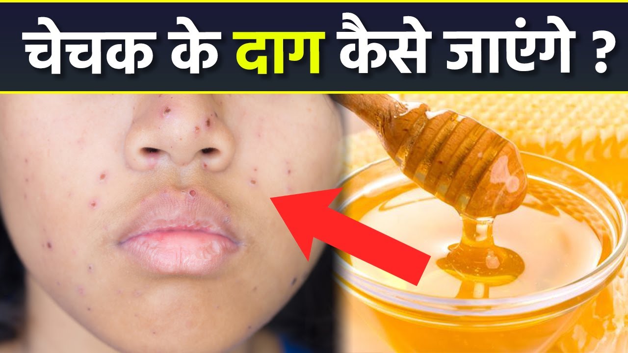 चेचक के दाग कैसे जाएंगे | Chechak ke daag hatane ka tarika | Boldsky ...