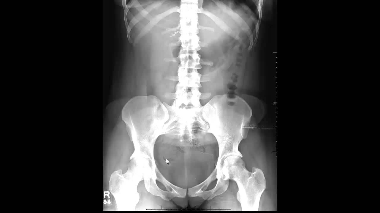 Introduction To The Abdominal KUB In The ER Setting YouTube