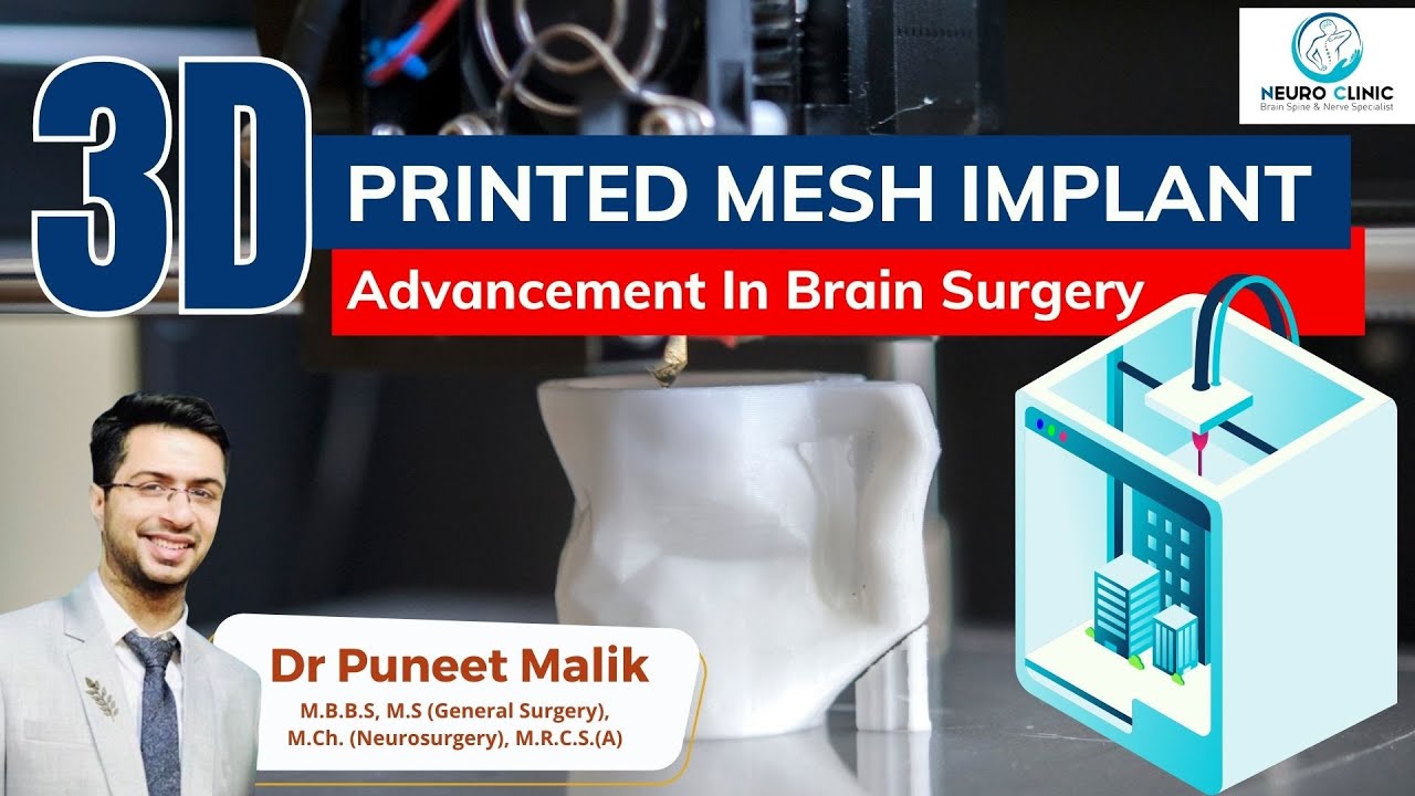 3D Printed Mesh Implant | Advancement In Brain Surgery | Dr Puneet ...