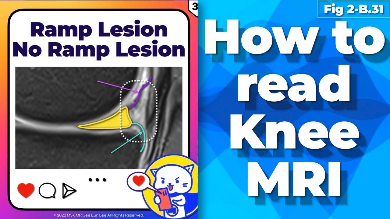 (Fig 2-B.31) Ramp lesion versus no ramp lesion in ACL injury - YouTube