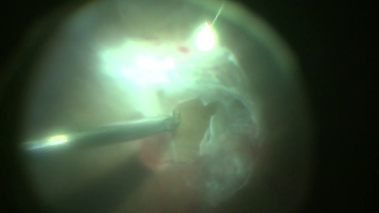 Surgery for Traction Retinal Detachment in Proliferative Diabetic ...